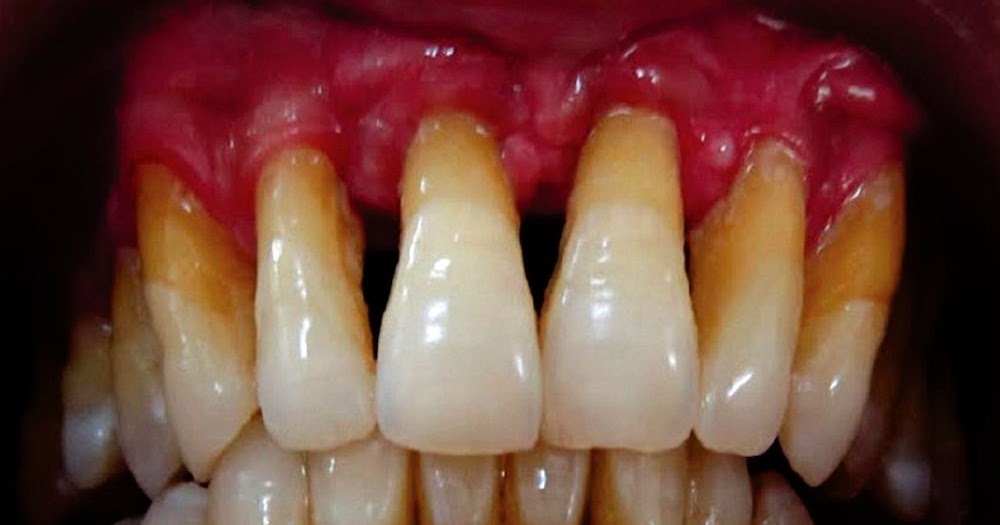 Periodontitis