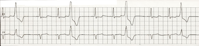 EKG Rhythm Strips 19: Ventricular Ectopy 2