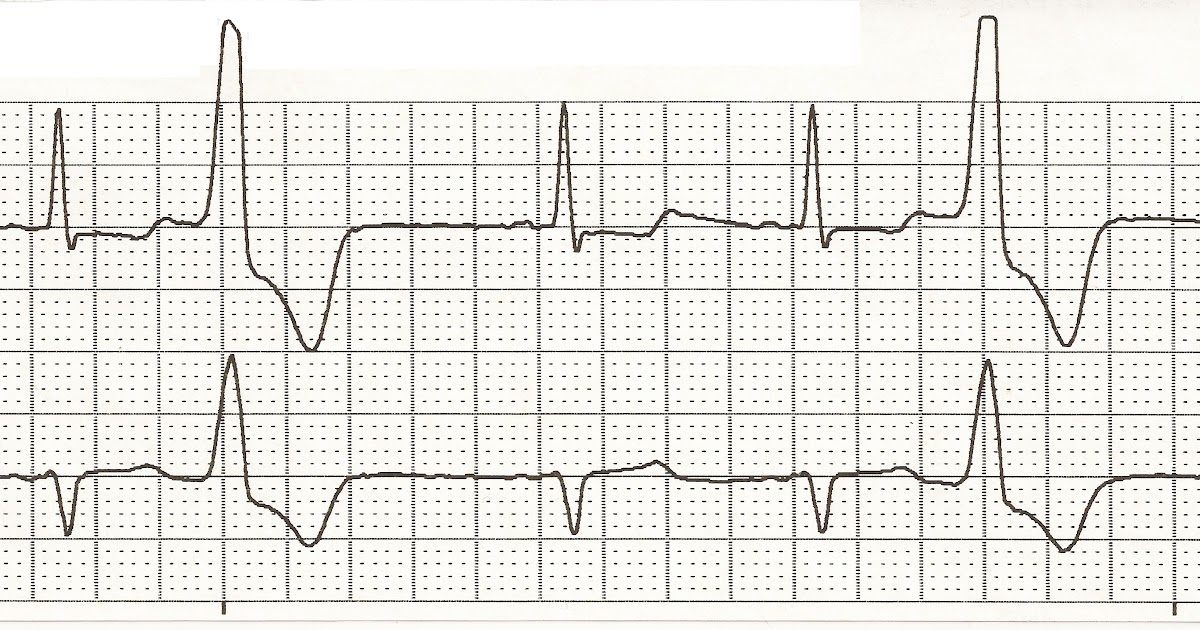 EKG Rhythm Strips 19: Ventricular Ectopy 2