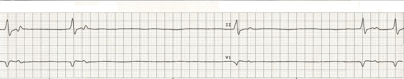 ACLS Rhythms: Ventricular rhythms