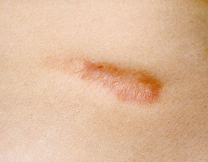 Apa itu Keloid | MANFAAT TUMBUH - TUMBUHAN