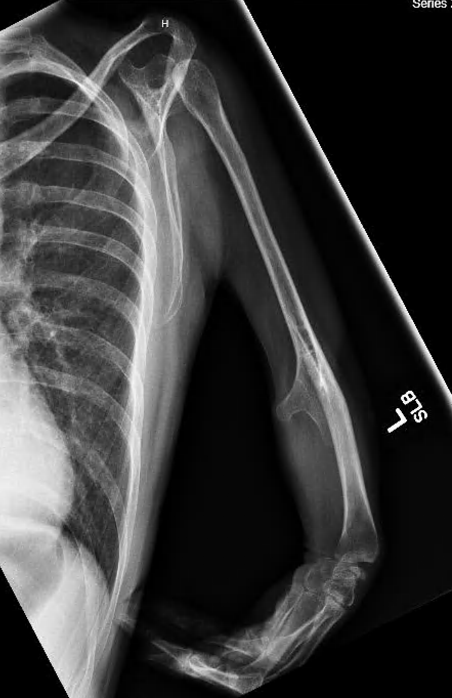Short arm and hand deficiency- phocomelia or longitudinal deficiency ...