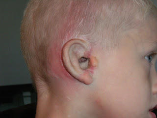 Robbies Little Nubby: Hole in Ear Drum and Another Mosquito Bite 7/11/11