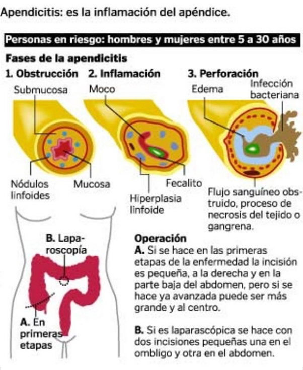 E.Bs.As: Inflamacion del apendice