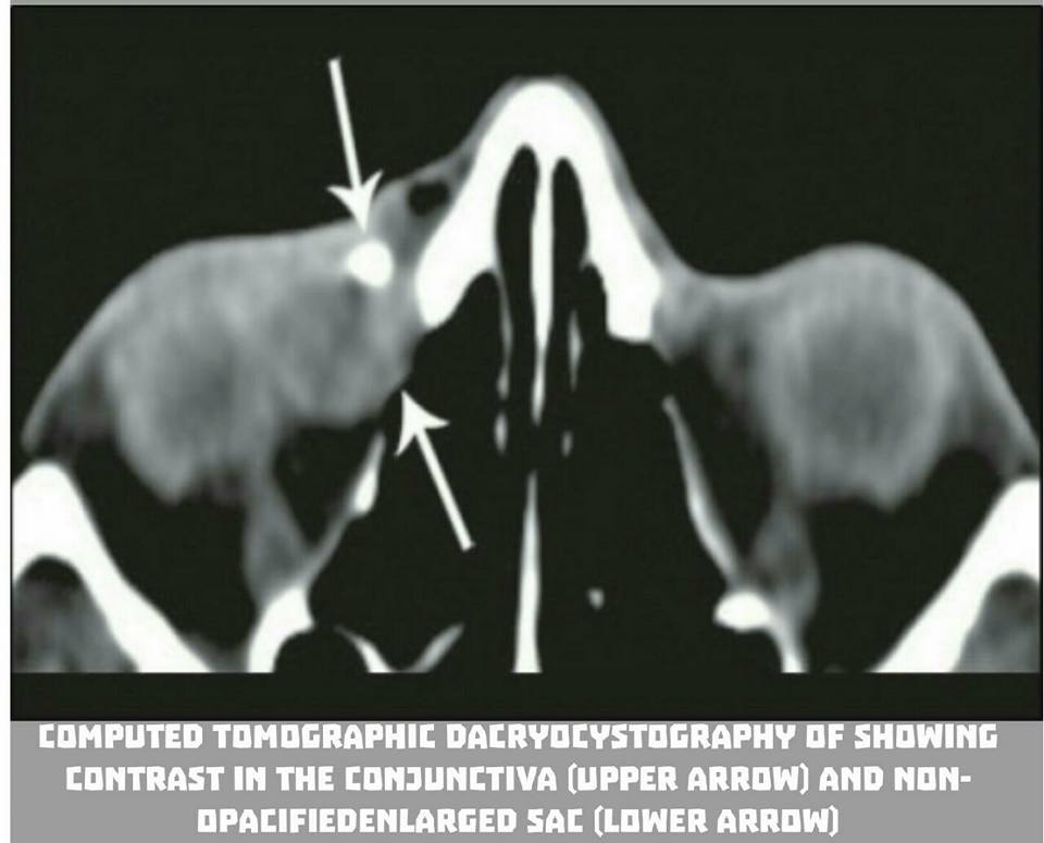 Technik Dacriografi ternyata masih di pakai - Seputar Kesehatan
