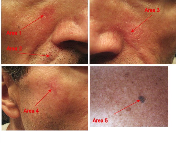 Steve's Bloodroot Blog