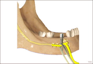 Federal Way Implant: Nerve Repositioning