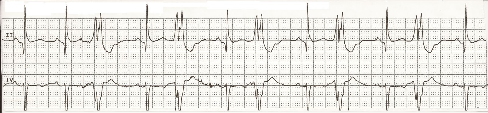 EKG Rhythm Strips: Bigeminy, Trigeminy, Quadrageminy
