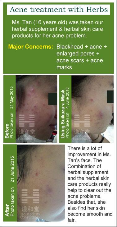 Chinese Medicine Doctor Ho in Sabah: Treat acne / pimples by Chinese ...