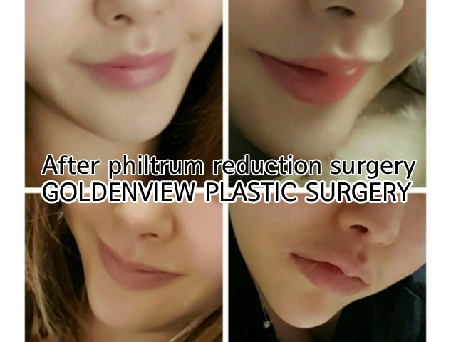 Goldenview Plastic Surgery Lip Lift Lip Plastic Surgery Phiptrum Reduction Surgery