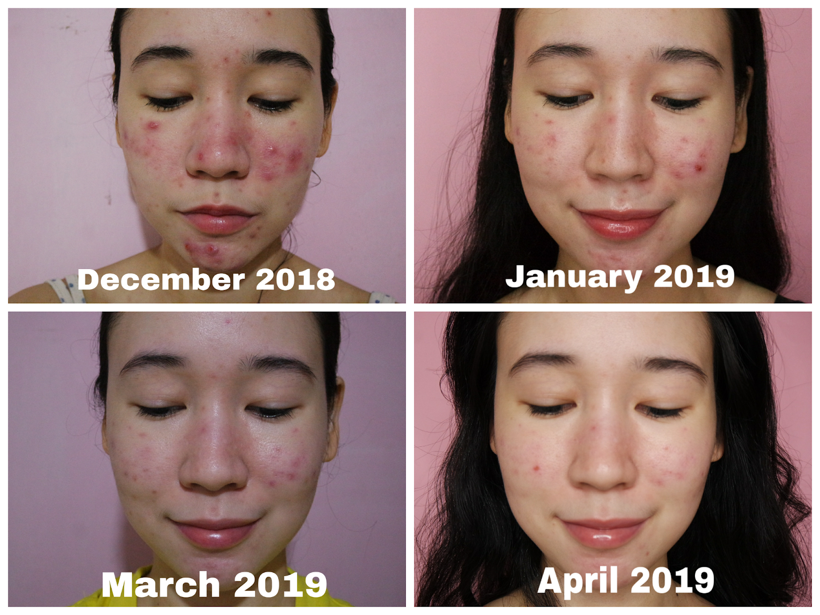 My ISOTRETINOIN JOURNEY (ACNOTIN/ACCUTANE) 6 MONTHS SKIN UPDATE ...