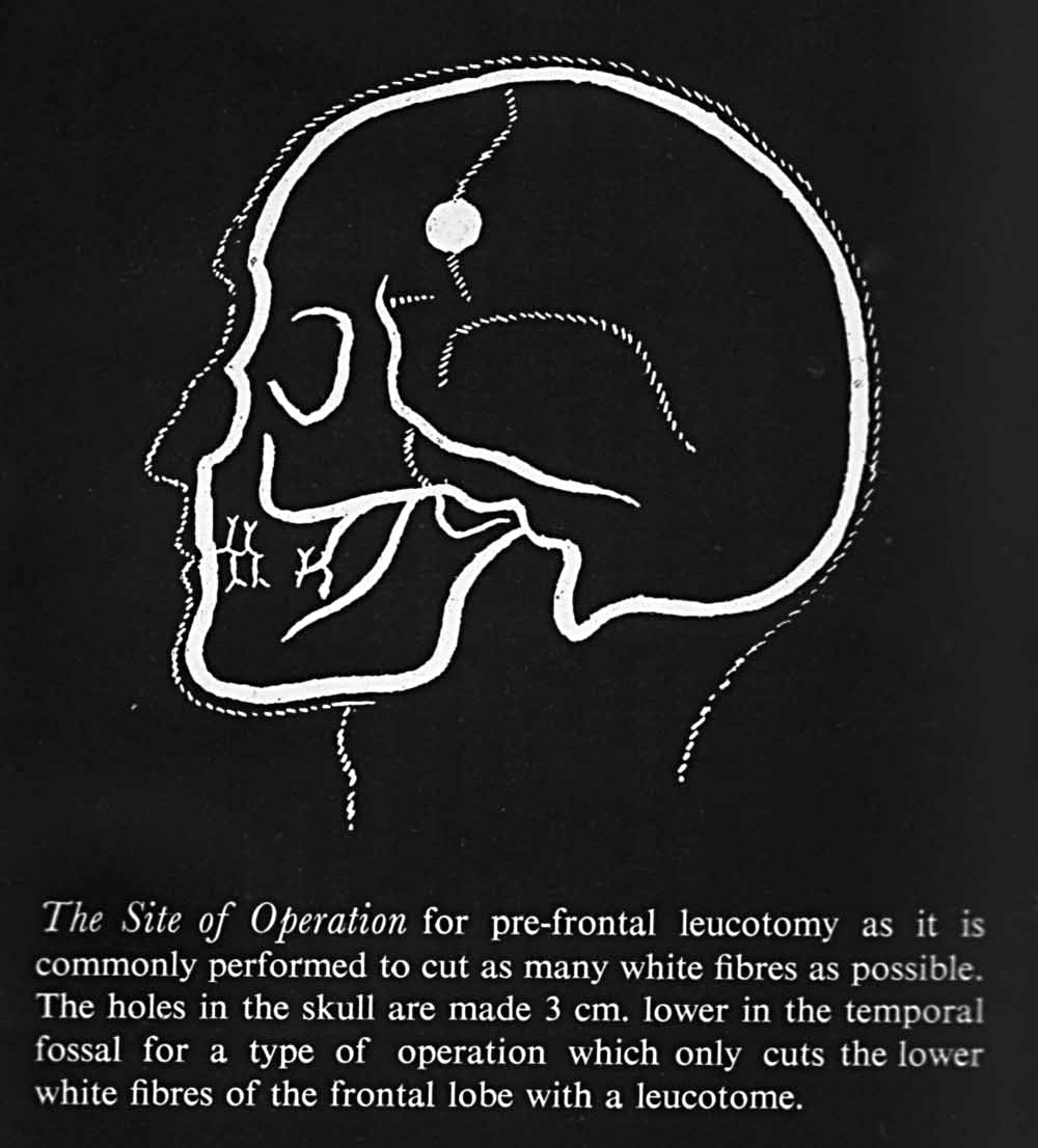 THE CONTROVERSIAL NEUROSURGERY: TRANSORBITAL LOBOTOMY