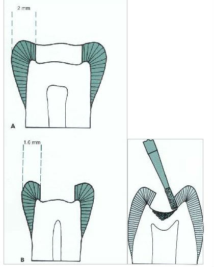 Restorasi Resin Komposit Kelas I | Dokter Gigi