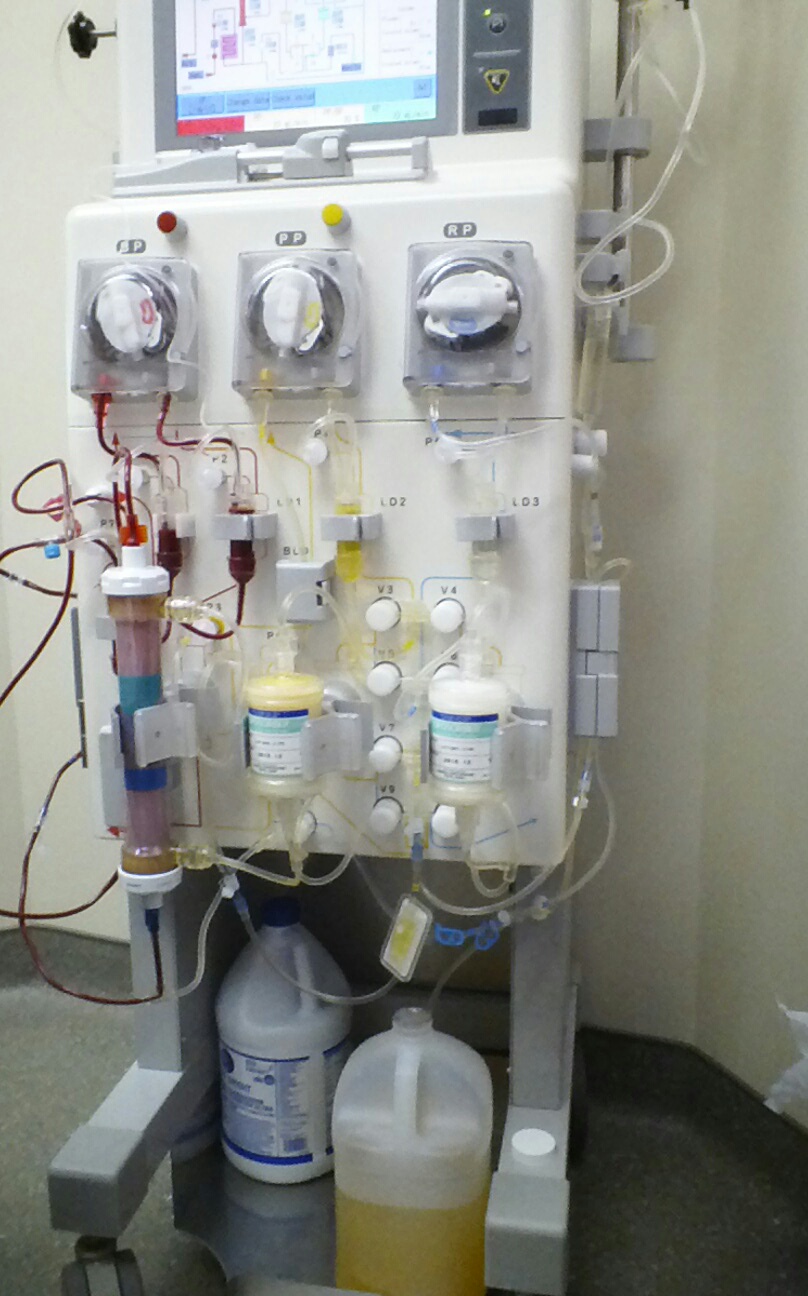 Familial Hypercholesterolemia diagnosis and LDL Apheresis treatment