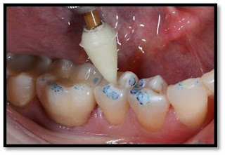 Blog Rasmi Bahagian Kesihatan Pergigian Negeri Perlis: Perkhidmatan ...