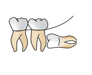 Classification of impacted mandibular third molar