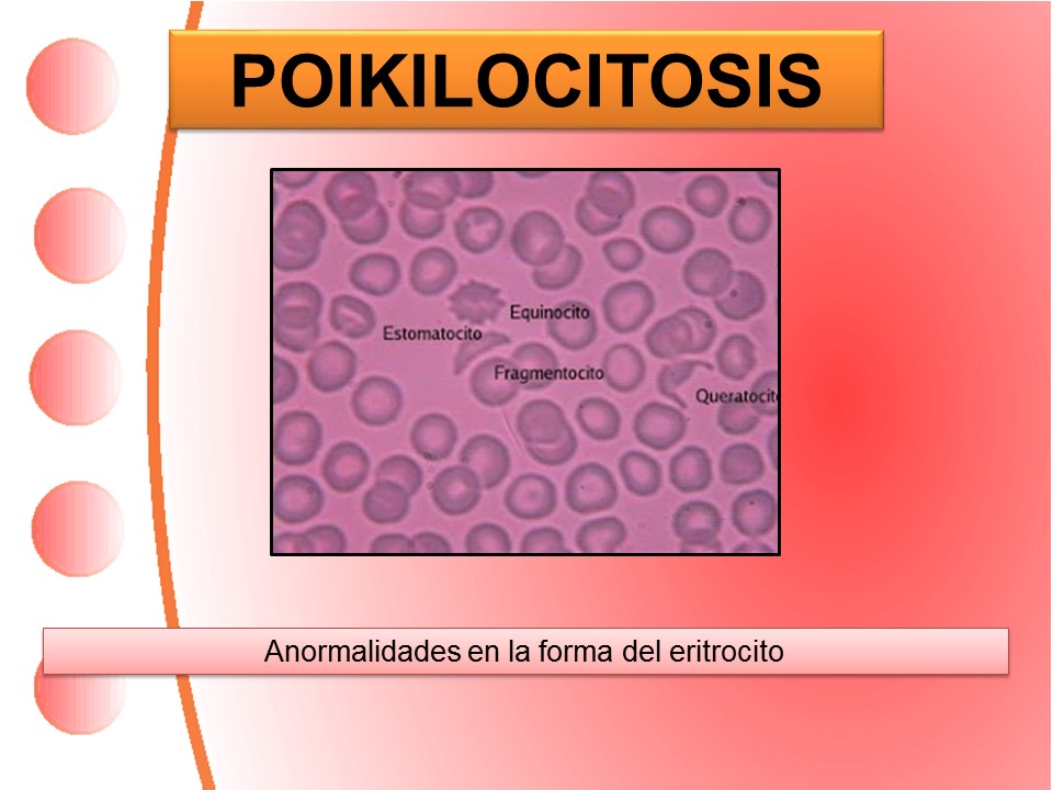 HEMATOLOGIA 2016 (FICHERO): POIKILOCITOSIS