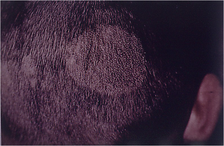 long life education: Tinea capitis