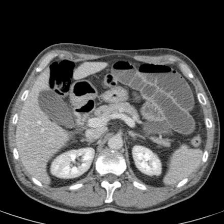 Dilated Small Bowel Differential Diagnosis - Radiology Imaging