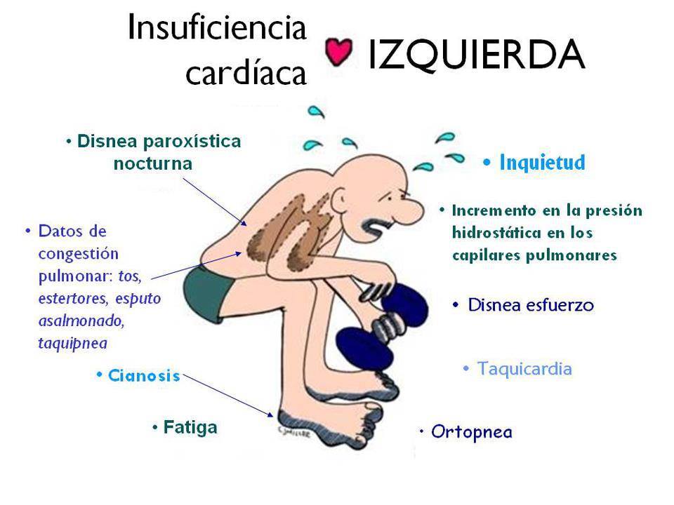 Insuficiencia cardíaca izquierda