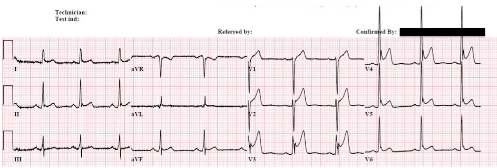 Dr. Smith's ECG Blog: Best Explanation of Terminal QRS Distortion in ...
