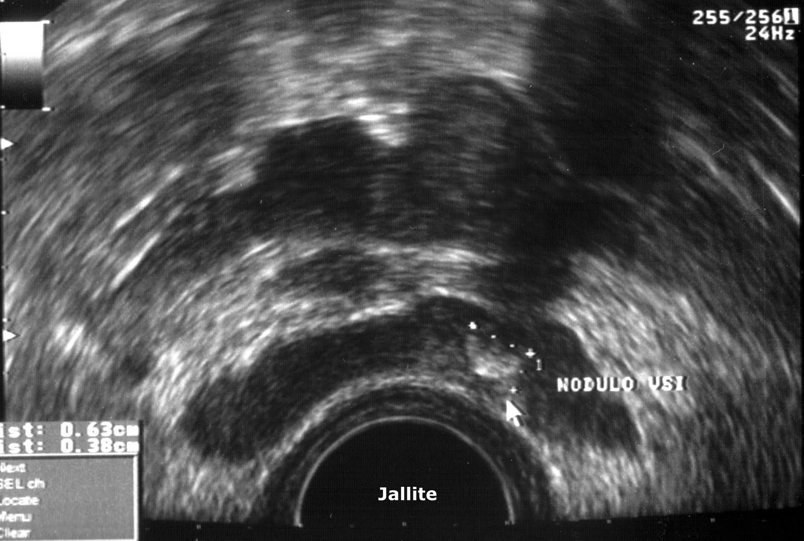 Nodulo Solido Vesicula Seminal