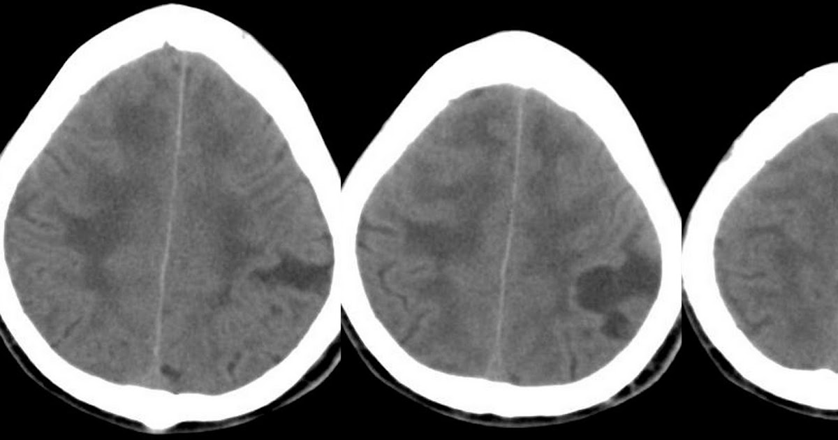 Dr Balaji Anvekar FRCR: Wide central sulcus