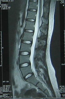 Acupuncture and Rehabilitation ( Road to full recovery): Lumbar ...