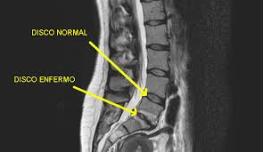 ARIS TRAINER: Causas de discopatía lumbar