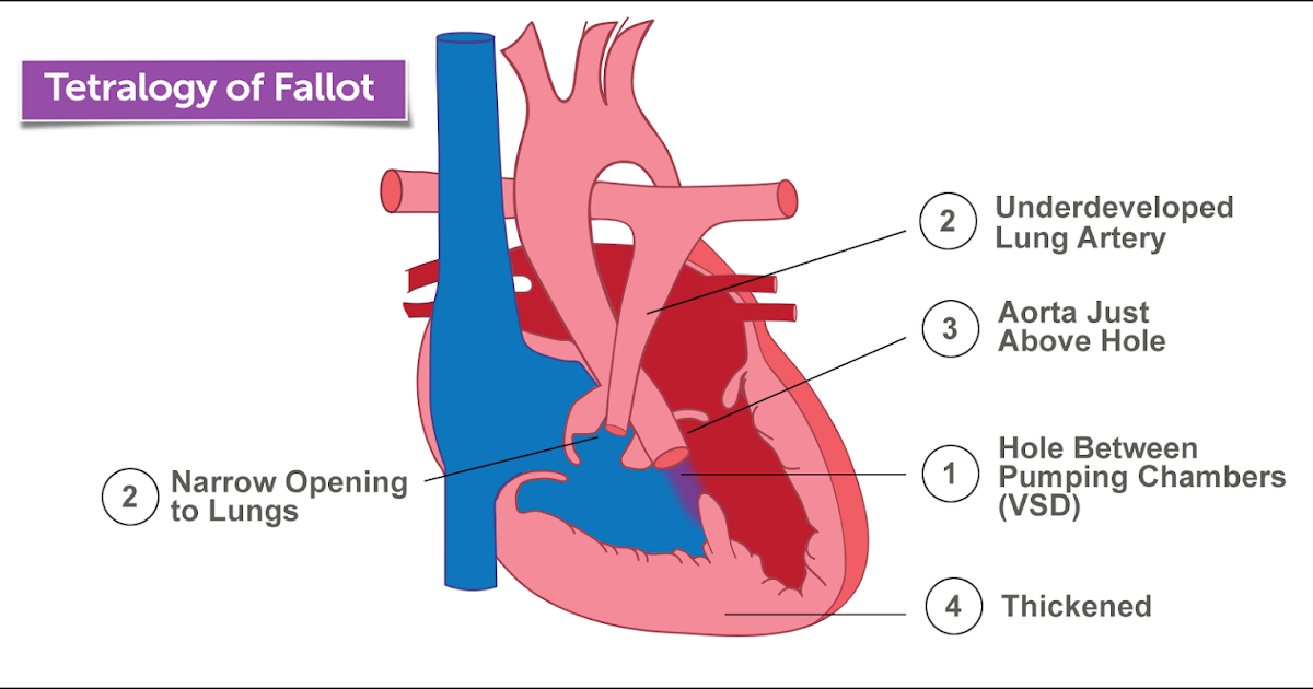 Pediatrics Notes: Brief Summary of Tetralogy of Fallot- A Congenital ...