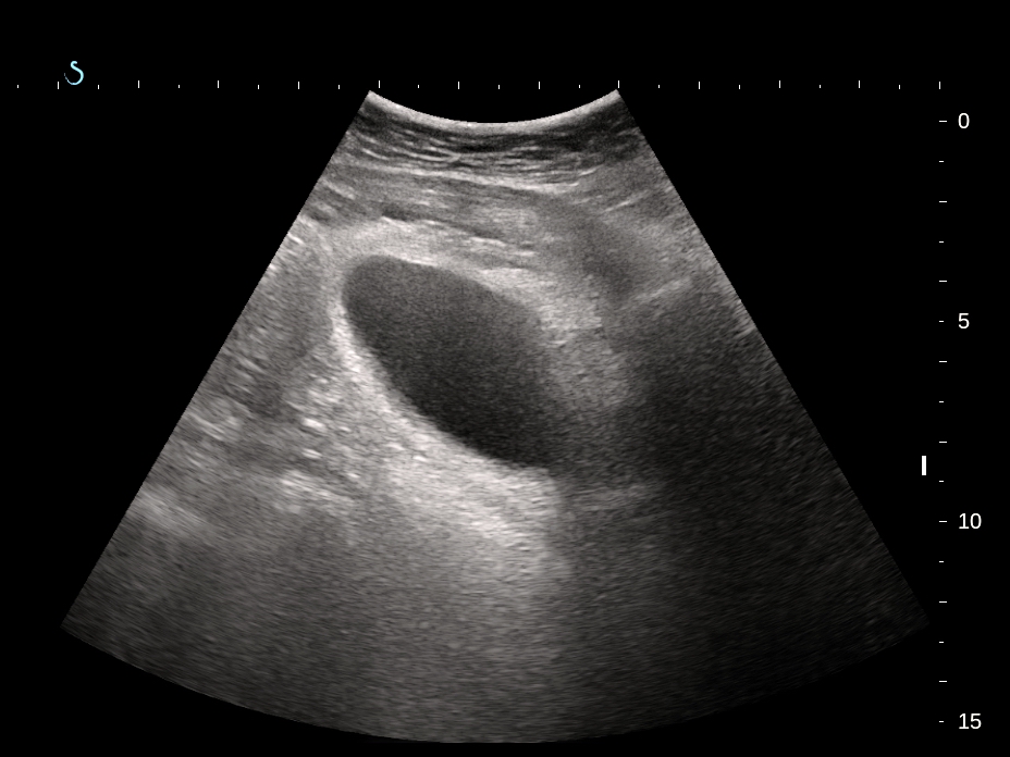 VIETNAMESE MEDIC ULTRASOUND: CASE 402 : DOUBLE URINARY BLADDER, Dr PHAN ...