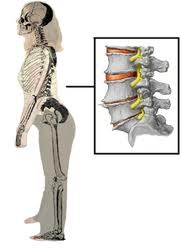Exercise and Posture: Lordosis