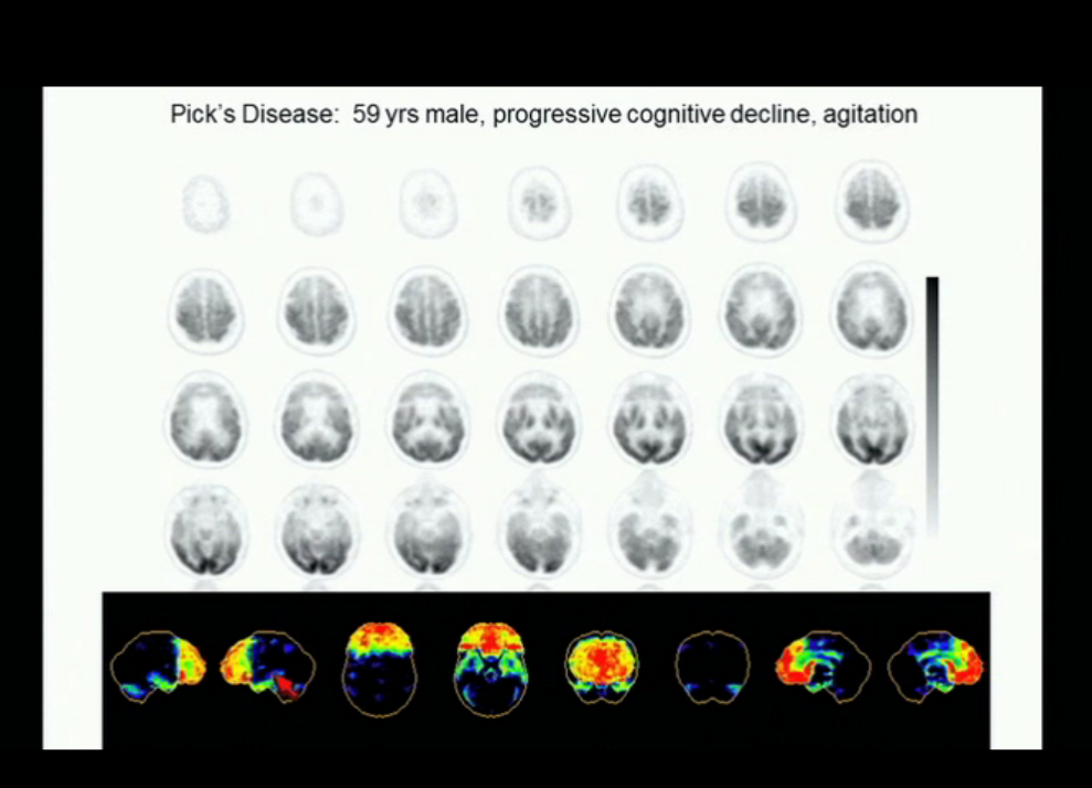 rsna: FDG PET for dementia