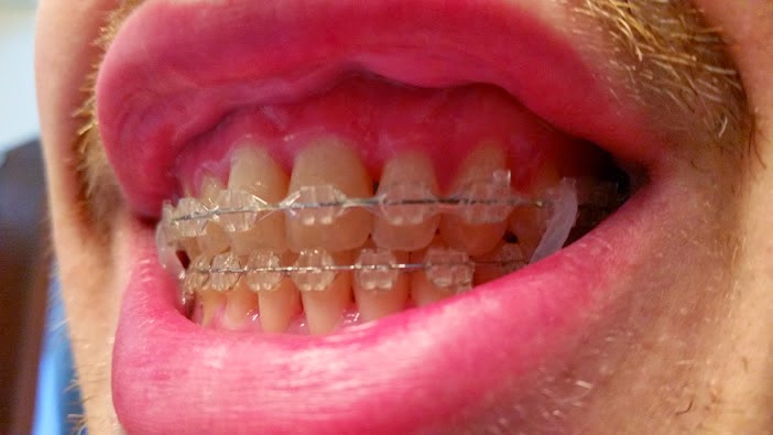 My SARPE Story: Something's Missing