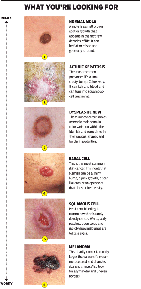 Skin Cancer Review by Rashid Mehmood