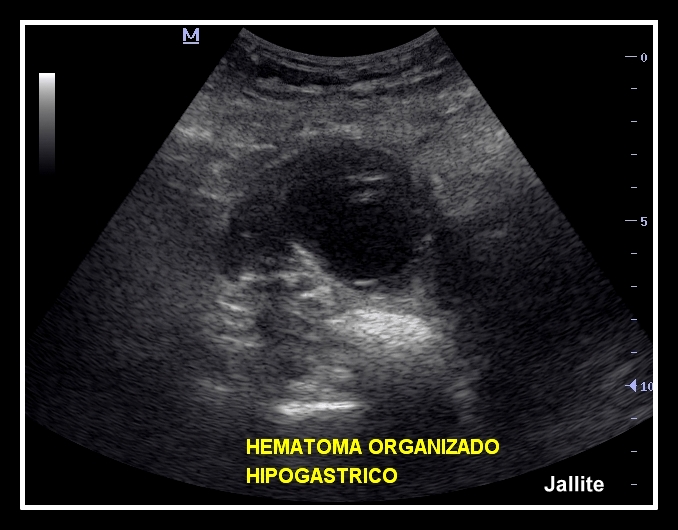 Hematoma Post-Cesarea