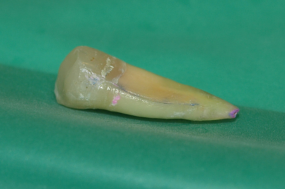 Clinica Omega: Fractura radicular