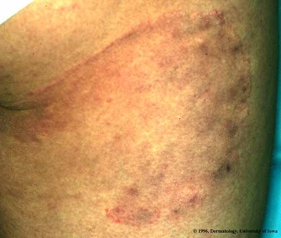 Belog Ammus: Ringworm atau Kurap [.]