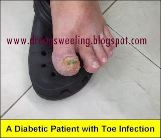 TCM News: TCM Physician Treat A Diabetic Patient with Toe Infection