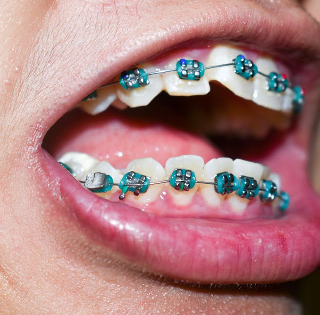 My Braces Journey: Part III (Pasang Behel di FDC - Sebulan Bersama ...