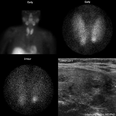 Roentgen Ray Reader: Delayed Activity on Dual-Phase Parathyroid Scans