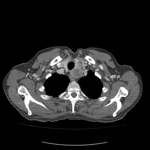 Post Gad: Multinodular Goitre