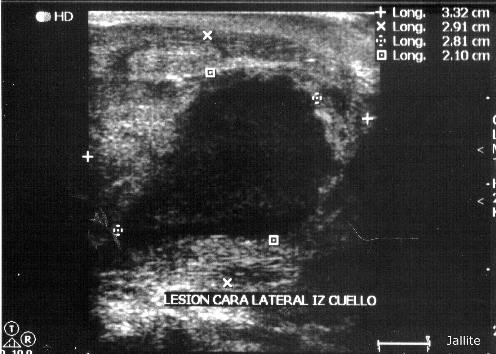 Absceso Cuello En Niño