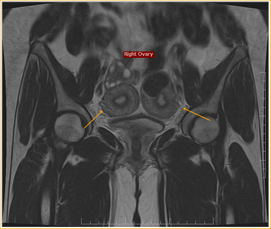Bicornuate Uterus: MRI - Sumer's Radiology Blog