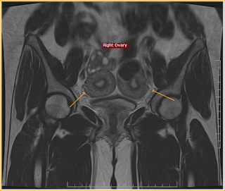 Bicornuate Uterus: MRI - Sumer's Radiology Blog