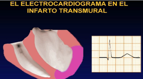 Electrocardiograma infarto transmural hiperaguda