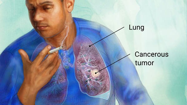 Wellness Lab Health Info: How Smoking Causes Cancer