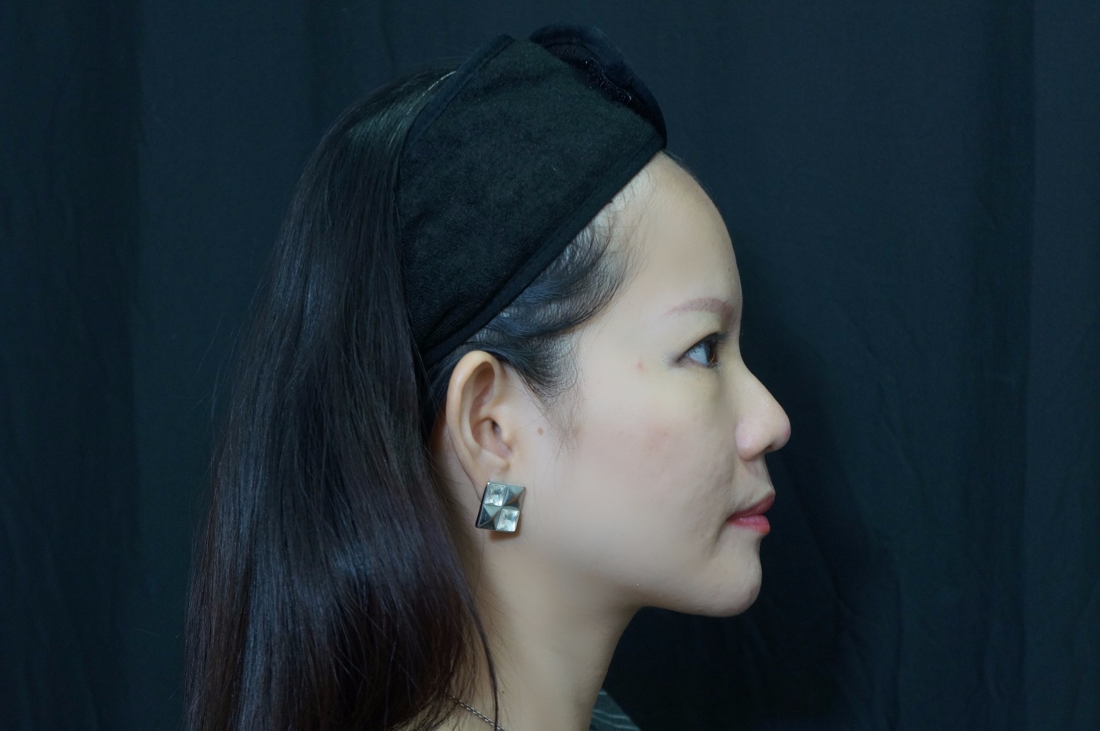 TheArcticStar's Tales: Review on Happy Lift Threadlift Procedure @ EHA ...