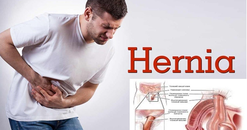 Bahaya Penyakit Hernia Penyebab Gejala dan Cara Mengatasinya - karya ...