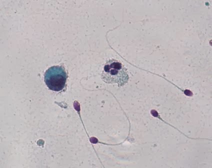 What do pus cells in the semen mean ? | The IVF Specialist's Blog for ...